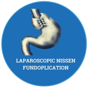 What is Laparoscopic Nissen Fundoplication reflux surgery? – Peptest ...